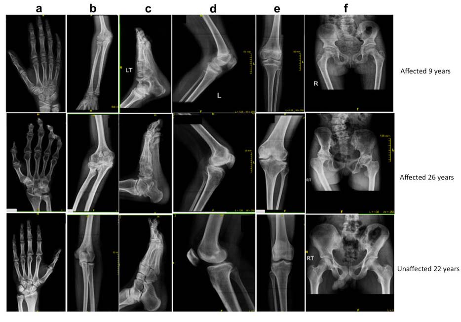 JK-DNA Talks...: Rare diseases otherwise, are common in Jammu and ...
