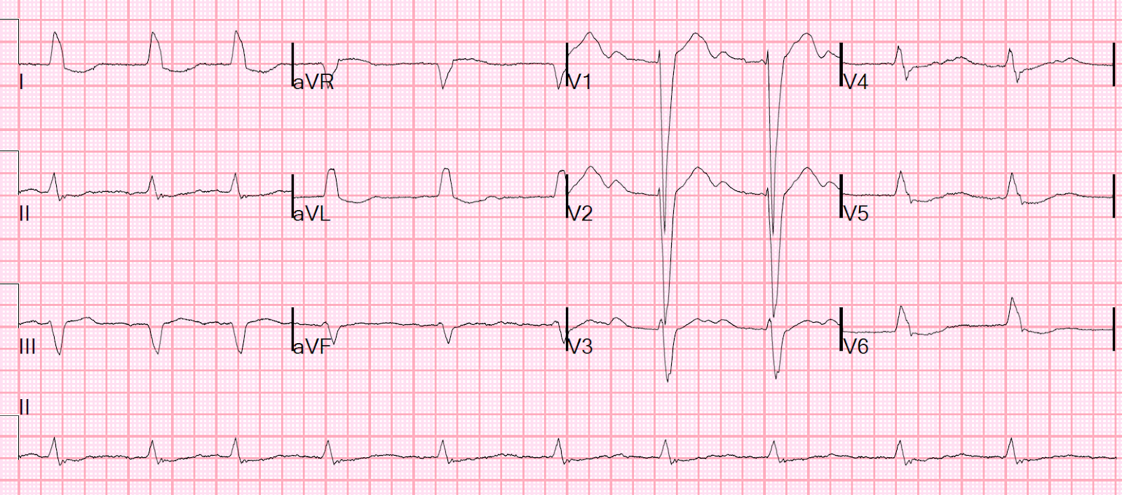 Bundle Branch Block
