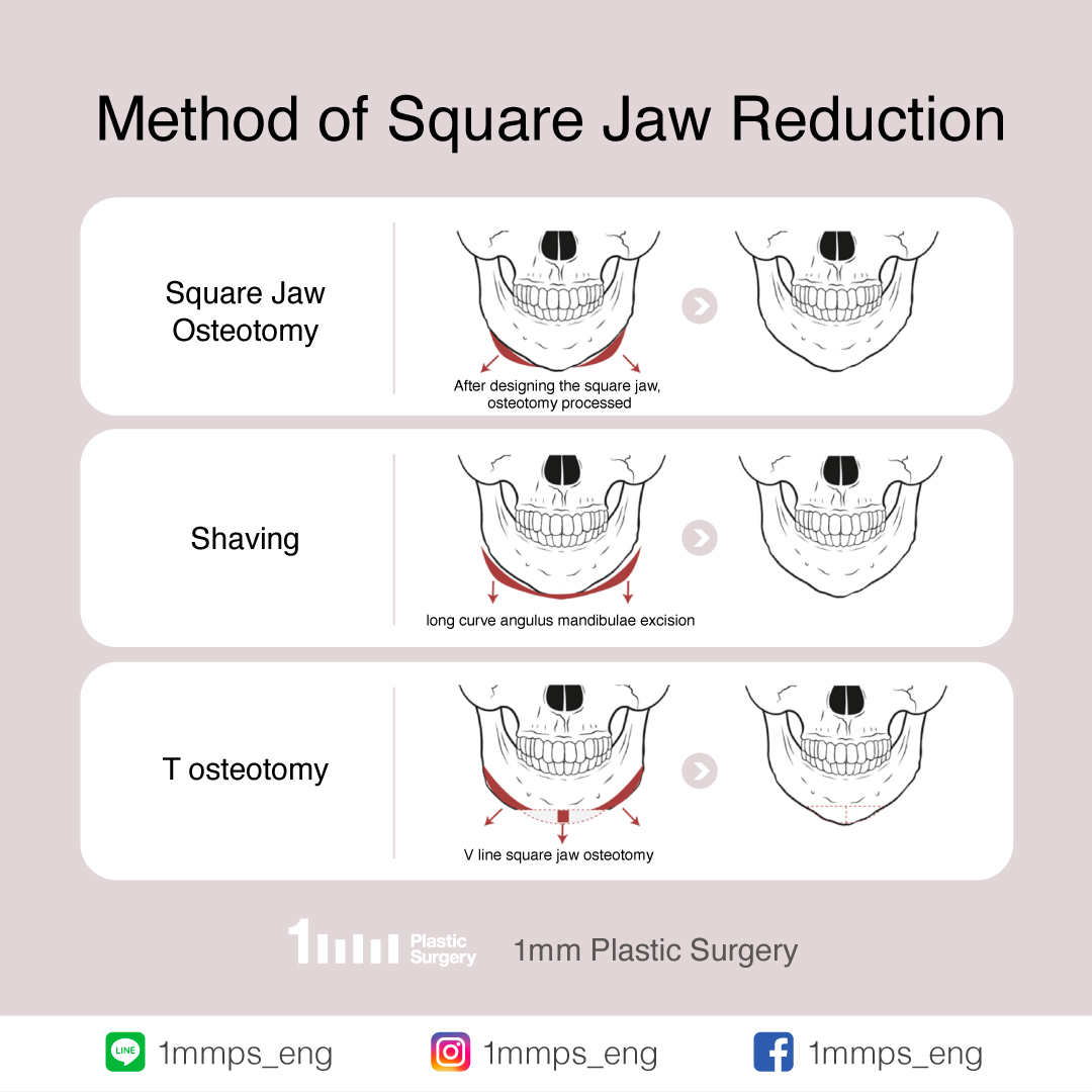 Square Jaw Reduction (see how we change you)