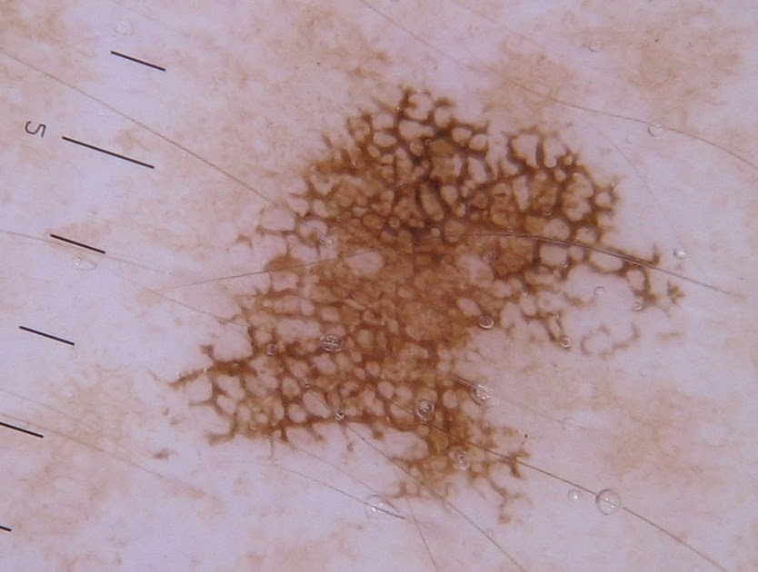 Dermoscopy Features as Clues: Lines Branched