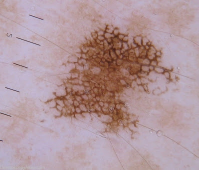 Dermoscopy Features as Clues: Lines Branched