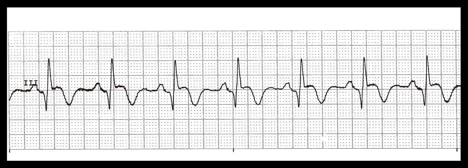 Practice EKG Strips 311