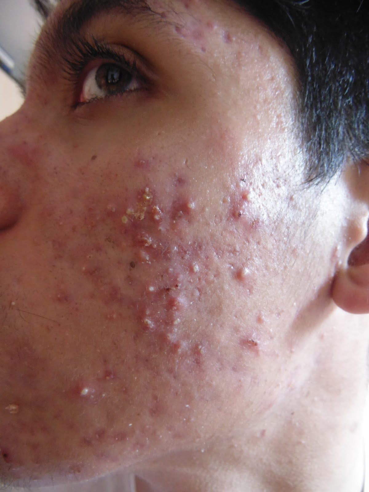 Retorno ao Dermatologista e Inicio do Tratamento com Roacutan ...