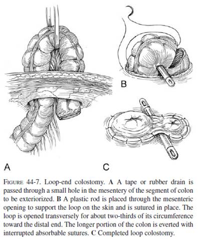 Sudiyatmo,MD Blog & Journal: INTESTINAL STOMA