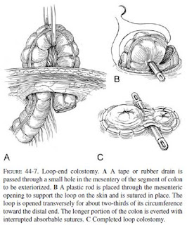 Sudiyatmo,MD Blog & Journal: INTESTINAL STOMA