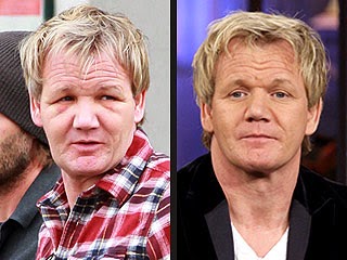Gordon Ramsay Plastic Surgery Facelift Before and After (Star plastic ...