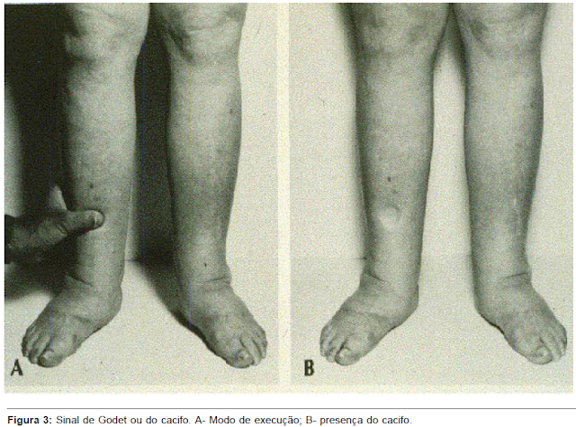 Mecanismos de Formação de Edemas ~ Fisionerds