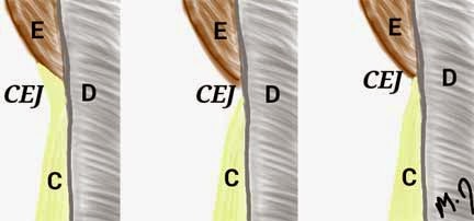 Cementoenamel Junction