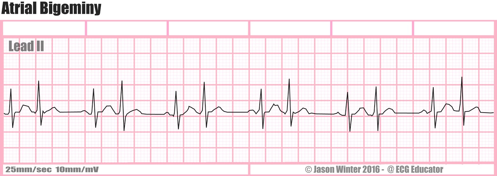 ECG Educator Blog : Six Second ECG Rhythm Strips