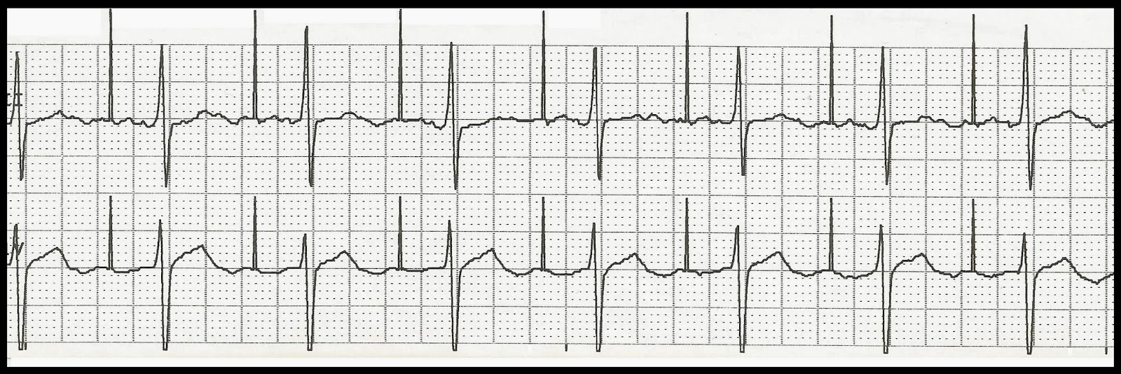 Practice EKG Rhythm Strips 215