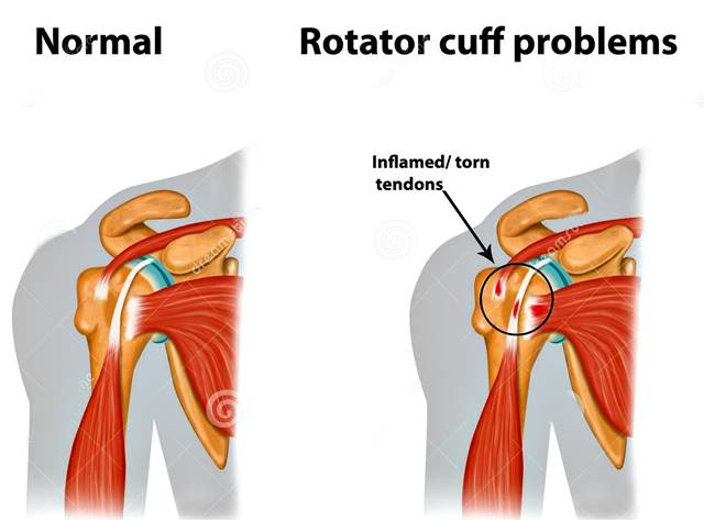 Subacromial impingement syndrome: Pain and Weakness of the Arm and ...