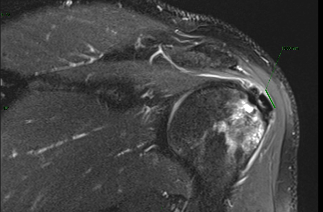 Hydroxyapatite crystal deposition disease (HADD): intraosseous ...