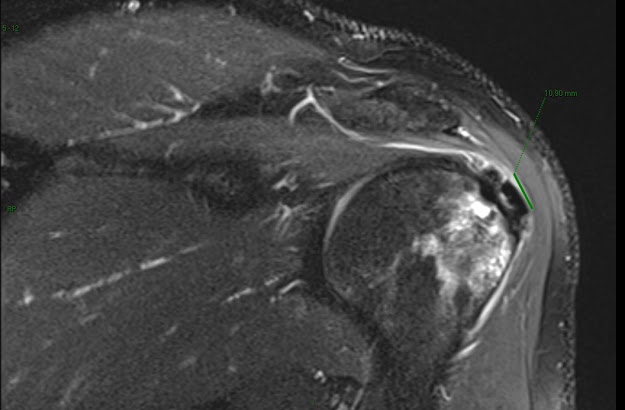 Hydroxyapatite crystal deposition disease (HADD): intraosseous ...