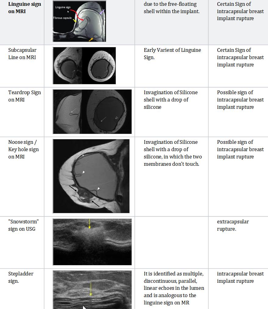 Radiological signs of breast implant rupture