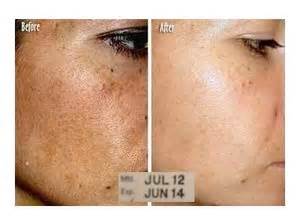 Tamara's: Age Spots, Acne, Sun Damage and Retinol