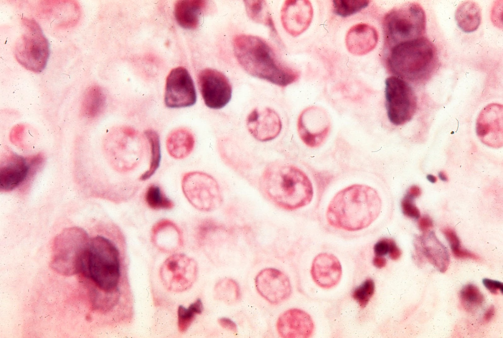 Histoplasmose Africana (Histoplasma duboisii) | Mundo Biologia