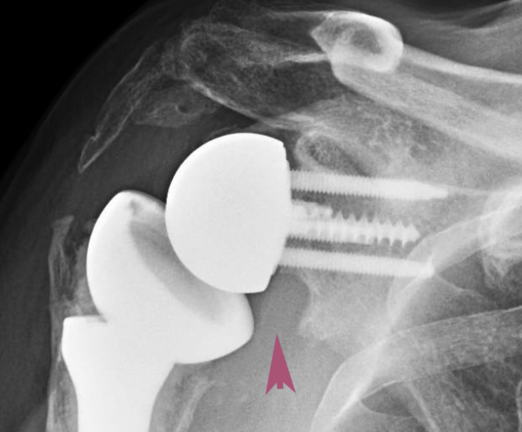 Shoulder Arthritis/Joint Replacement Rotator cuff tears: Reverse total ...