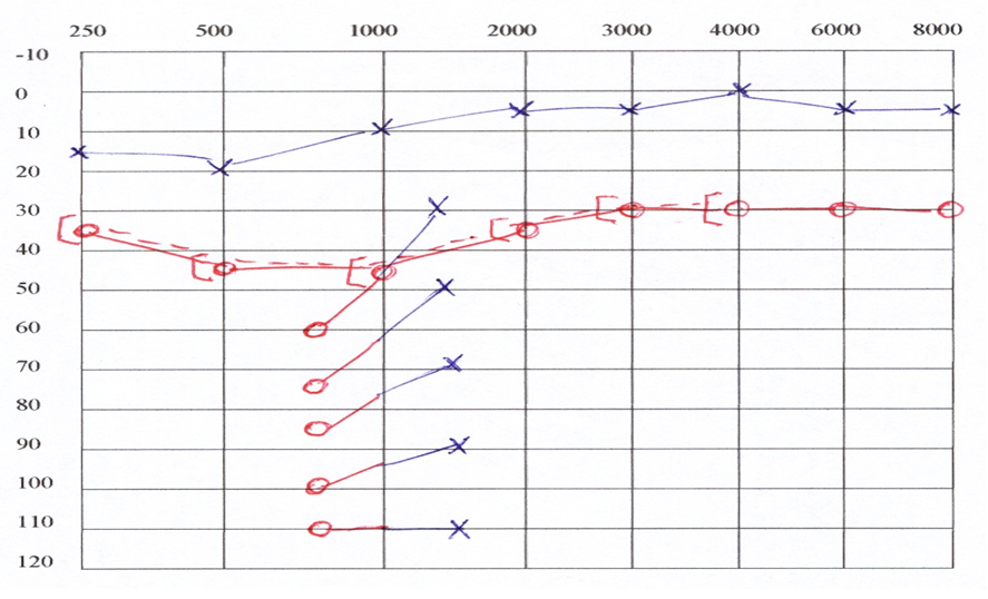 Pruebas Especiales Supraliminares para la Detección de Reclutamiento ...