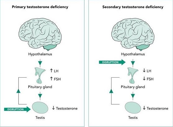 Testosterone Deficiency in Men: Causes, Symptoms, Tests, Treatment and ...