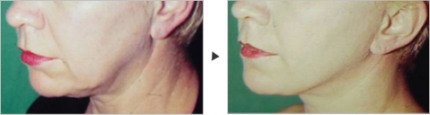 Clique Clinic: Ultra V Lift