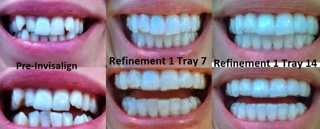 Michelle's Invisalign Journey