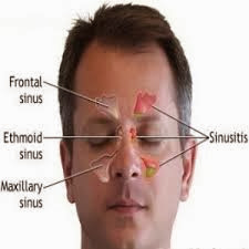 Radang Sinusitis: Radang Pada Sinus