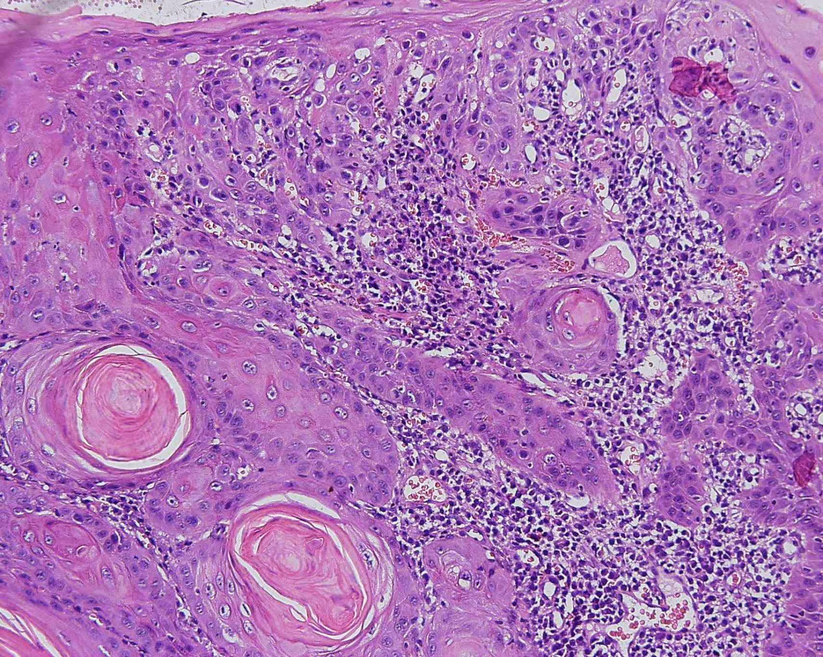 Estomatologia Online: Carcinoma de Células Escamosas