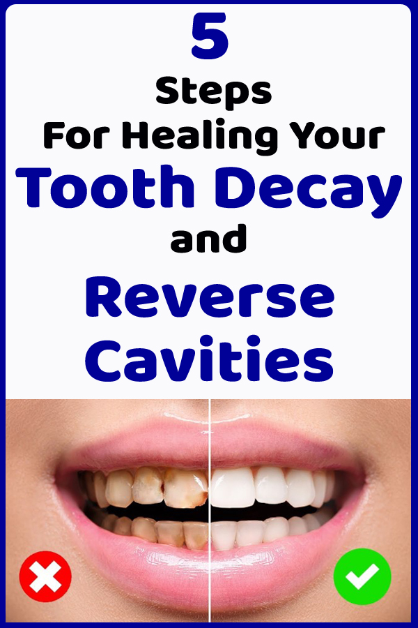 5 Steps For Healing Your Tooth Decay and Reverse Cavities