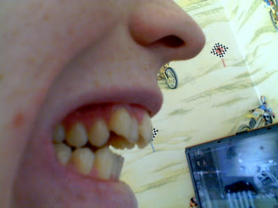 Orthodontie + rétrognathie mandibulaire: Place aux photos