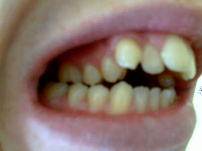 Orthodontie + rétrognathie mandibulaire: Place aux photos