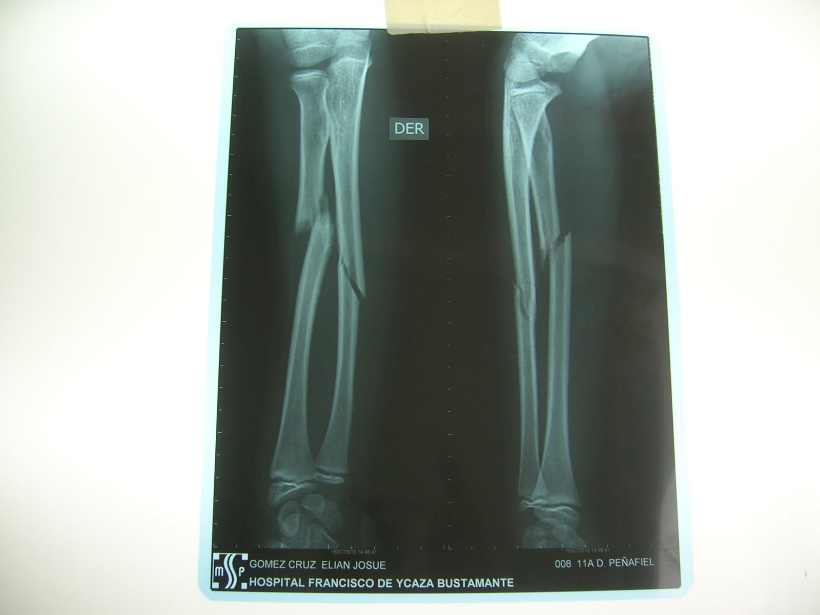 Fractura de Cubito y Radio