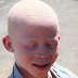 African Albinos Fight for Survival ~ Personal Blog of Zuzeeko Abeng