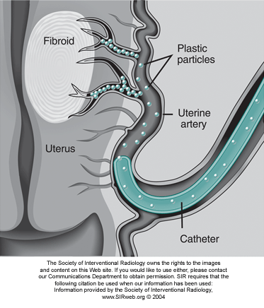 Uterine Artery Embolisation May Adversely Affect Future Pregnancies