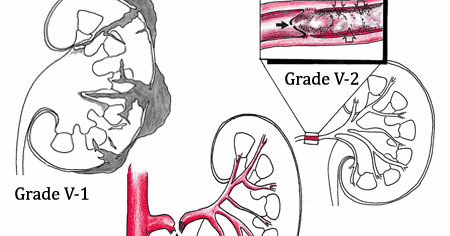 - Renal trauma grading scale.