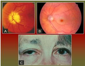 Trastornos asociados a Discapacidad Visual Blog Atendiendo Necesidades