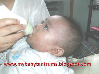 My Baby Tantrums And My Baby Diary: Baby Rashes After High Fever