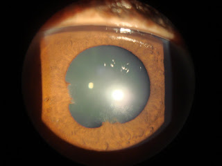 how to take care of your eyes: POSTERIOR SYNECHIA