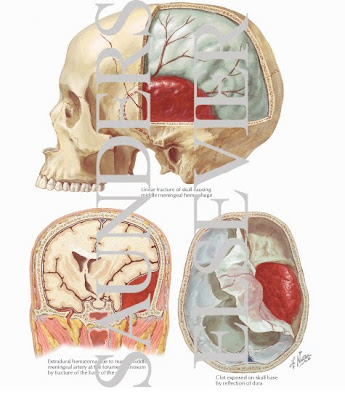PG Medic: Subdural/Extradural Hematoma