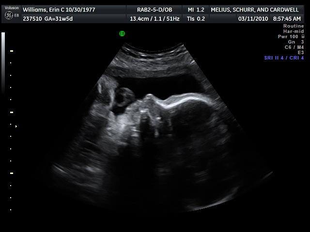 Williams' Pregnancy: ULTRASOUND WEEK 32, SIDE