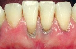 sonrisas bellas: CALCULO DENTAL