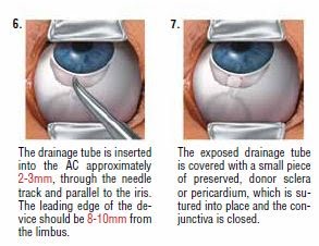 Ismu Eh: Abdul Mateen Ahmed and his glaucoma valve