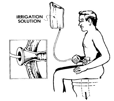 Yatinah Desniar Waruwu: PERAWATAN KOLOSTOMI (COLOSTOMI CARE)