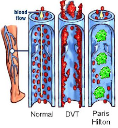 Deep Vein Thrombosis Blog