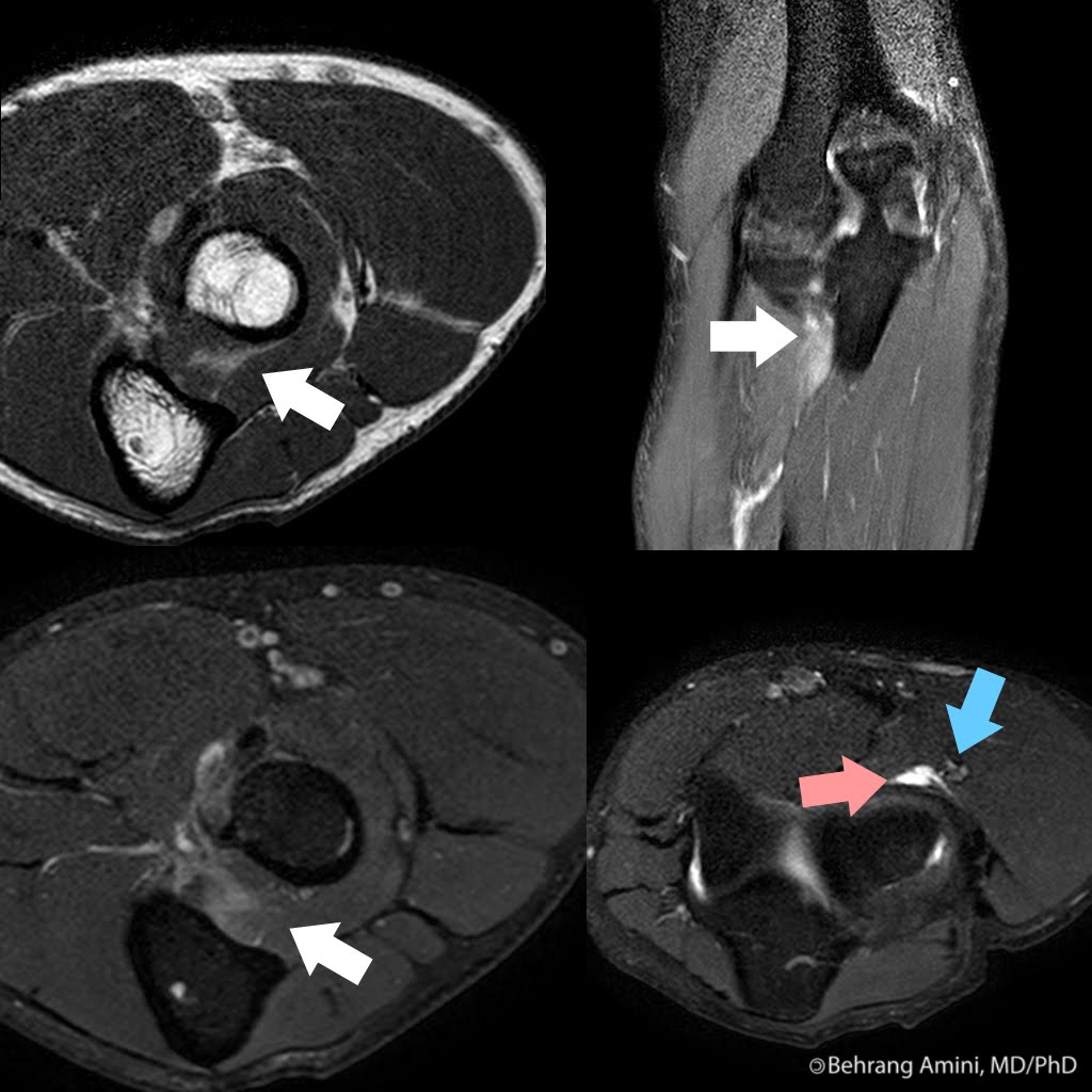 Roentgen Ray Reader: Supinator Syndrome