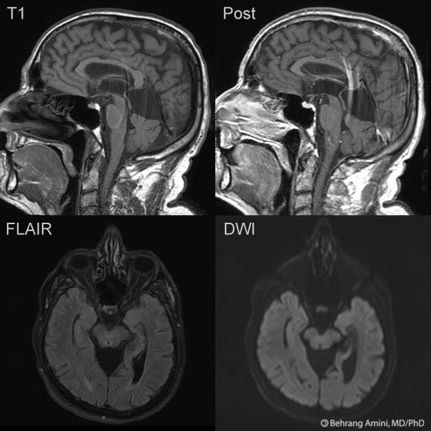 Roentgen Ray Reader Quadrigeminal Plate Arachnoid Cyst