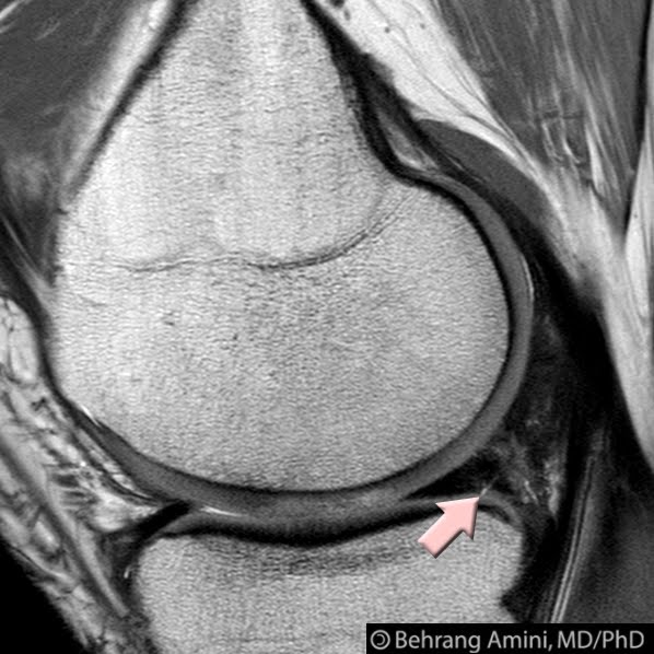 Roentgen Ray Reader: Red Zone of the Menisci