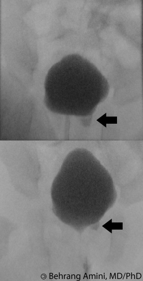 Roentgen Ray Reader: Bladder Ears (Transitory Extraperitoneal Hernia of ...
