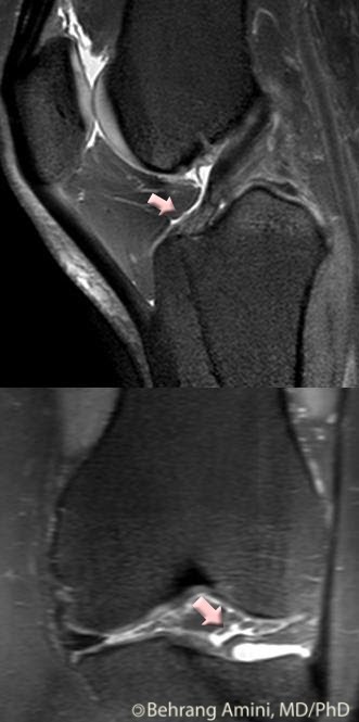 Roentgen Ray Reader: The Infrahoffatic Recess