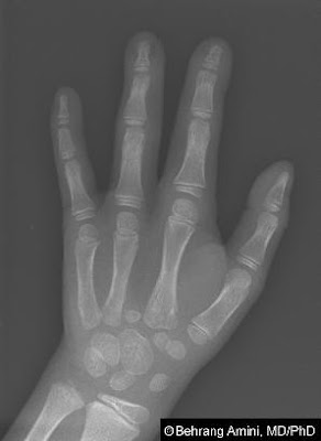 Roentgen Ray Reader: Ectrodactyly