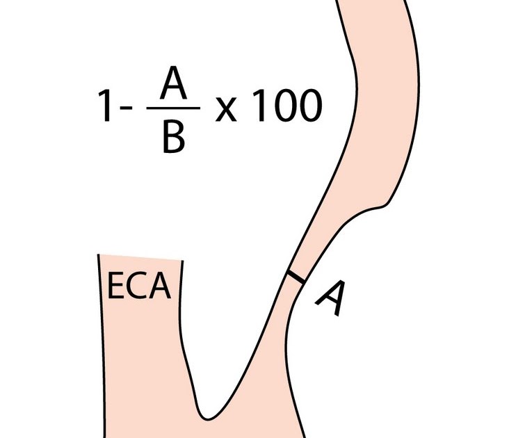 Roentgen Ray Reader: NASCET Criteria for Carotid Stenosis